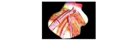Laparoscopic Varicocelectomy Surgery