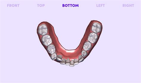 Crowding And Tooth Rotation Realistic Outcome From Clear Aligners 4