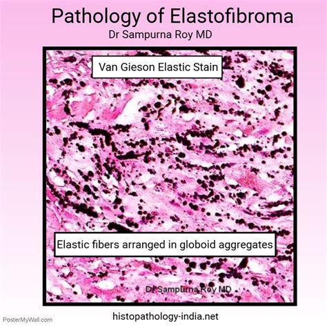 Pathology Of Elastofibroma Softtissuepathology Dermatopathology