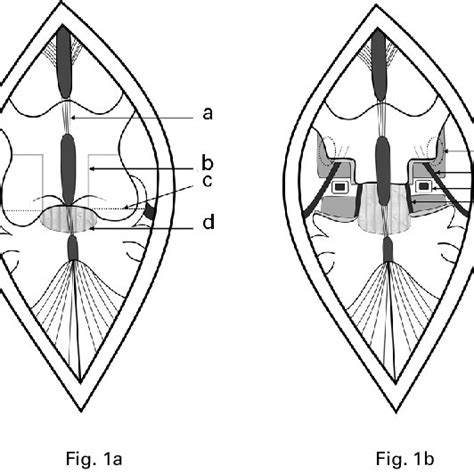 A Schematic Diagram Showing The Midline Structures A Spinous Process Download Scientific
