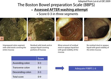 Top Tips For Evaluating And Cleaning Up Bowel Preparation
