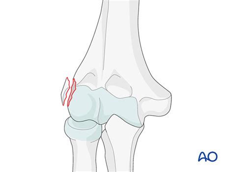 Epicondylus Lateralis Humeri Epicondylus Lateralis Humeri Radiograph