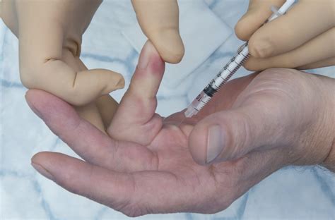Dupuytrens Contracture Collagenase Xiapex Injection And Manipulation