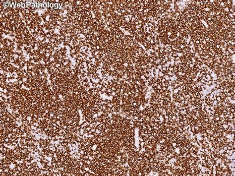 Aitl Immunophenotype Cd5