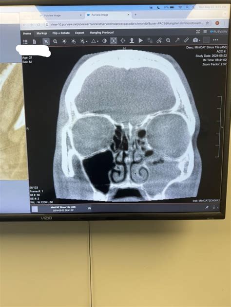 Sinus Surgery Questions R Sinusitis
