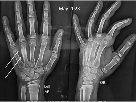 Chronic Recurrent Multifocal Osteomyelitis A Care Reportpptx
