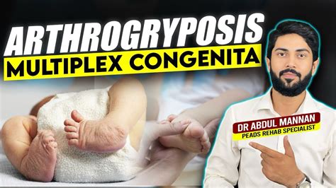 Understanding Arthrogryposis Multiplex Congenita Causes Symptoms And