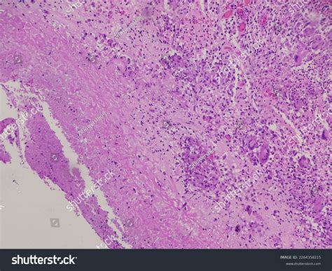 Lymphadenitis Tuberculosis There Caseosa Necrotic Epithelioid Stock