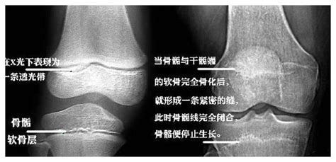 【科普】警惕！儿童身高发育的终点——骨骺线闭合信号，切莫错过！ 医谱