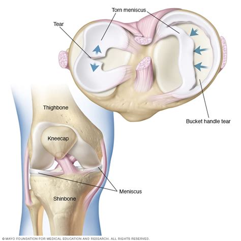 Knee Pain Symptoms And Causes Mayo Clinic