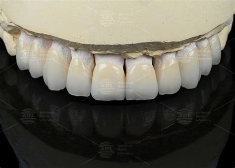 Natural Tooth Color Ceramic Feldspathic Veneer For Anterior And