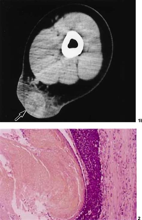 Figure 1 From Extraordinarily Large Calcifying Epithelioma Without