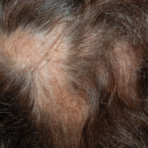 Facial Dysmorphism With A Flat Nasal Bridge Prominent Frontal Bossing