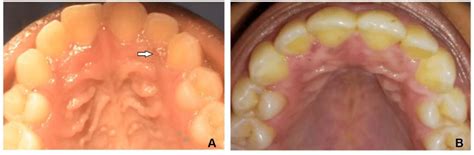 A Pre Operative Photograph The Arrow Shows The Site Of Lymphangioma Download Scientific