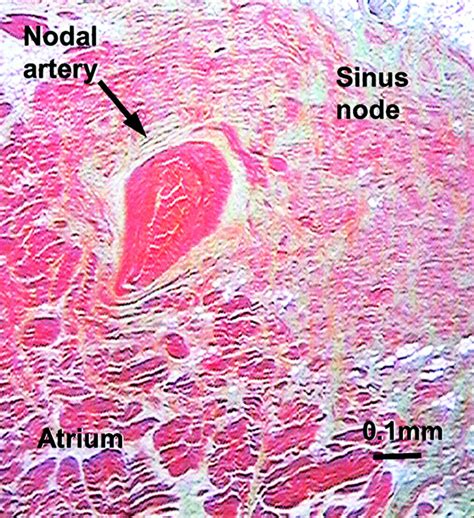 Anatomic Electrophysiological Correlations Concerning The Pathways For Atrioventricular