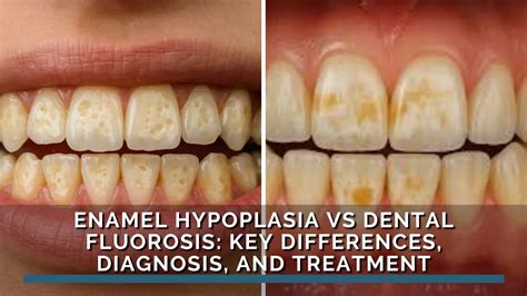 Enamel Hypoplasia Vs Dental Fluorosis Key Differences Diagnosis And