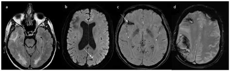 Treatment Related Reversible Cerebral Vasoconstriction Syndrome