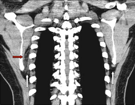Figure 12 From Presentation Of Elastofibroma Dorsi In Ct And Mri