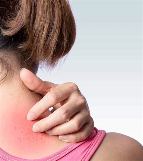 Heat Rash In Adults Guide To Causes Symptoms And Treatment