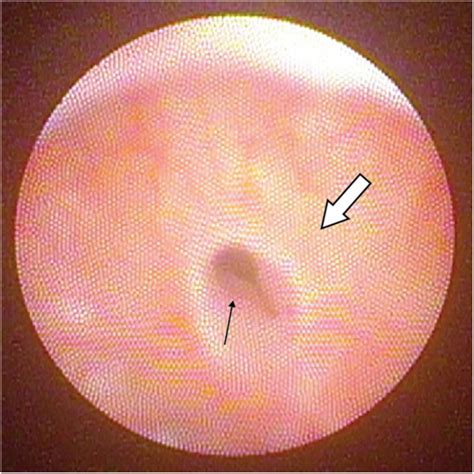 Cystoscopy To Investigate The Prevalence Of Prostatic Utricle Cyst In