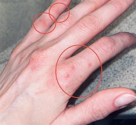 Red Spots Fingers Hand Rashes Foothill Dermatology Medical Center