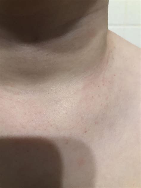 Petechiae Neck