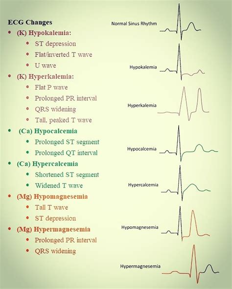 Hypomagnesemia Ecg
