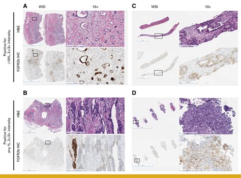 Prevalence Of Fgfr2b Protein Overexpression In Advanced Gastric Cancers