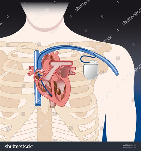 Schematic Sketch Pacemaker Elements On Separate Stock Vector Royalty