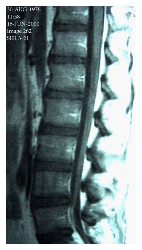 T1 Weighted Mri Scans With Contrast Of Lumbar Spine In A Sagital And
