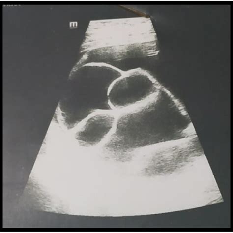 Pelvic Ultrasound Showing A Multilocular Mass Download Scientific Diagram