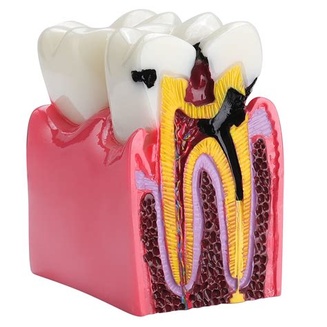 Buy Dental Caries Tooth Model 6 Times Tooth Decay Model Dental Models