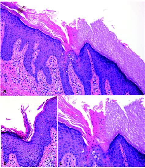 Histopathological Examination A The Obliquely Oriented Cornoid Download Scientific Diagram