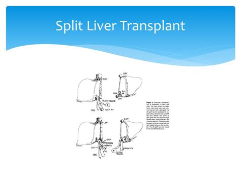 Ppt Pediatric Liver Disease Powerpoint Presentation Free Download