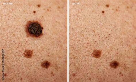 Photo Before And After Removal Of Mole On Woman Skin Mole Removal