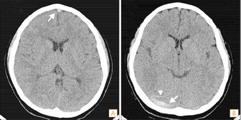 Brain Ct Findings The Ct Shows Hyperattenuation Segments At The