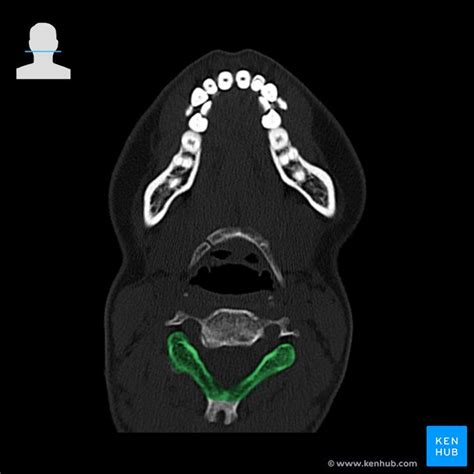 Vertebral Arch Structure And Function Kenhub
