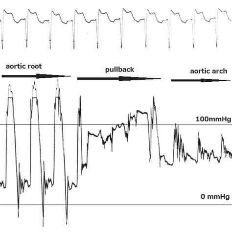 Aortography After The Aortic Root Replacement The Arrows Indicate The Download Scientific