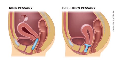 Vaginal Pessaries Brazosport Womens Health