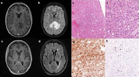 Case Study Of Rare Nervous System Tumor Reveals Hypermutation Best