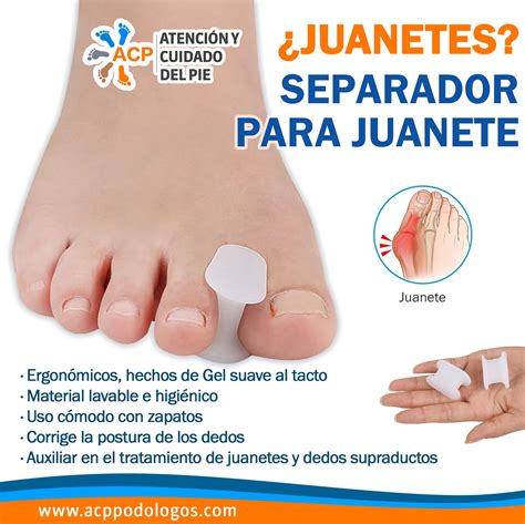 Acp Juanete O Hallux Valgus El Hallux Valgus O Juanete Es Un Bulto óseo De Hueso En La