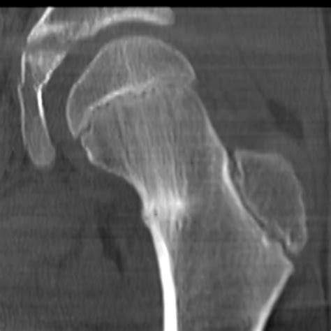Types Of Femoral Neck Stress Fractures At Alica Tjalkabota Blog