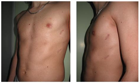 Severe Pectus Excavatum