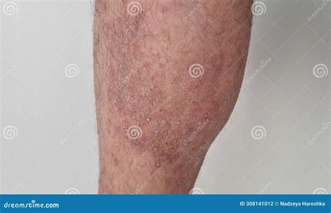 Dermatological Skin Disease Psoriasis More Pronounced On Elbow Hand