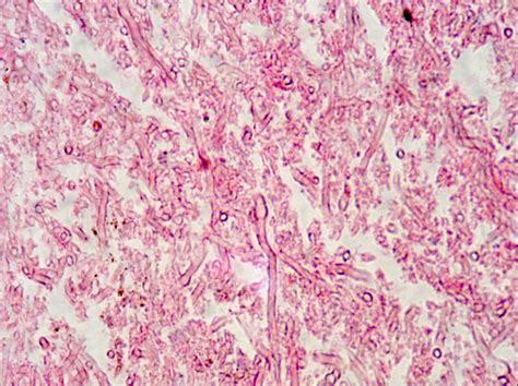 Pathology Outlines Aspergillus