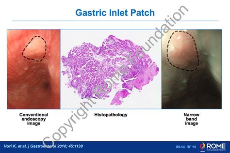 Esophagus 14 Gastric Inlet Patch Rome Online