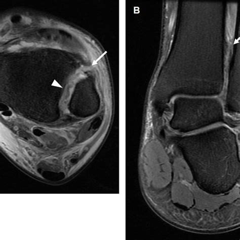 Schneck Grading System And Sikka Classification For Grading Of The Download Scientific Diagram