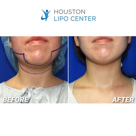 Houston Lipo Center On Linkedin Houstonlipocenter Lipohouston