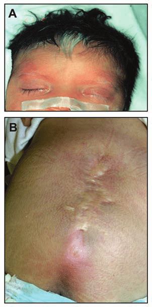 Waardenburg Syndrome A Face Showing White Forelock And White Left