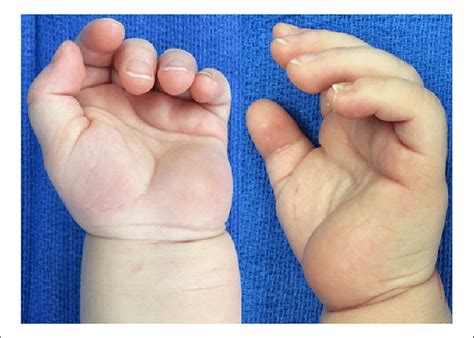 Preoperative Photographs Of A Mass In The Hypothenar Eminence
